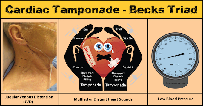 Mnemonics For Heart Sounds